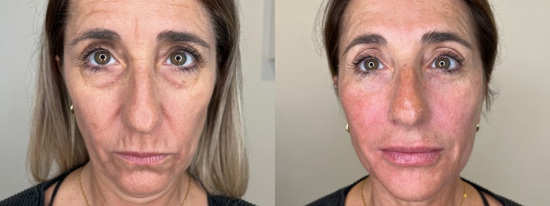 Lifting Effect - Dr Djoon Clinique