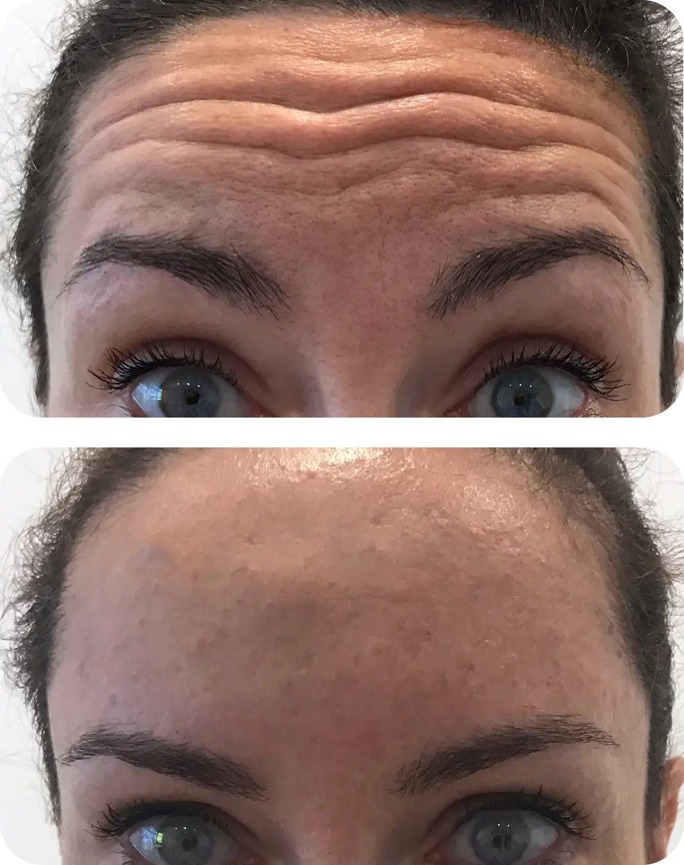 Acide Hyaluronique - Dr Djoon Clinique